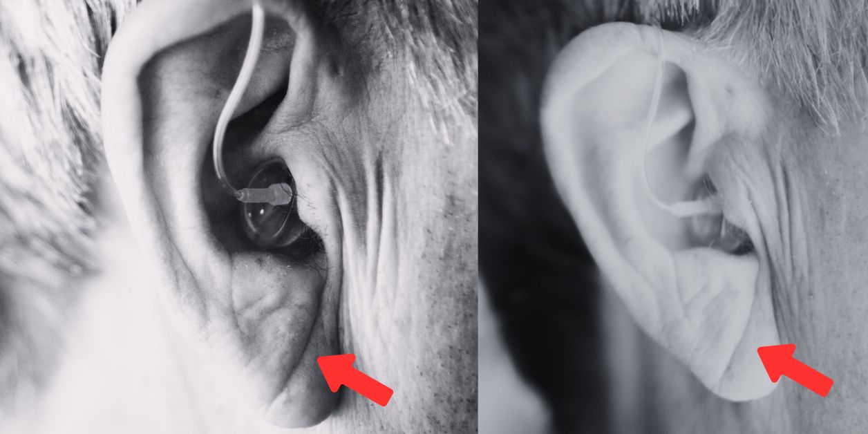 Znak Franka na uchu — Powiązanie diagonalnej zmarszczki na